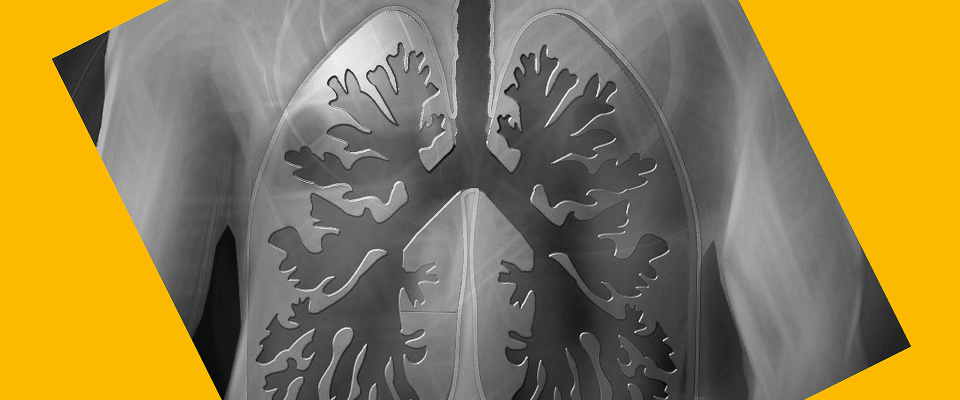 Insights Into Autoimmune Pulmonary Alveolar Proteinosis Solaris Health